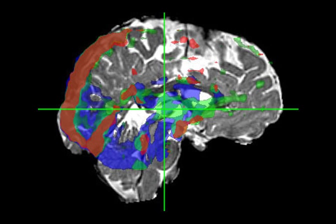 New MRI technique maps fluid velocity distribution in the brain ...